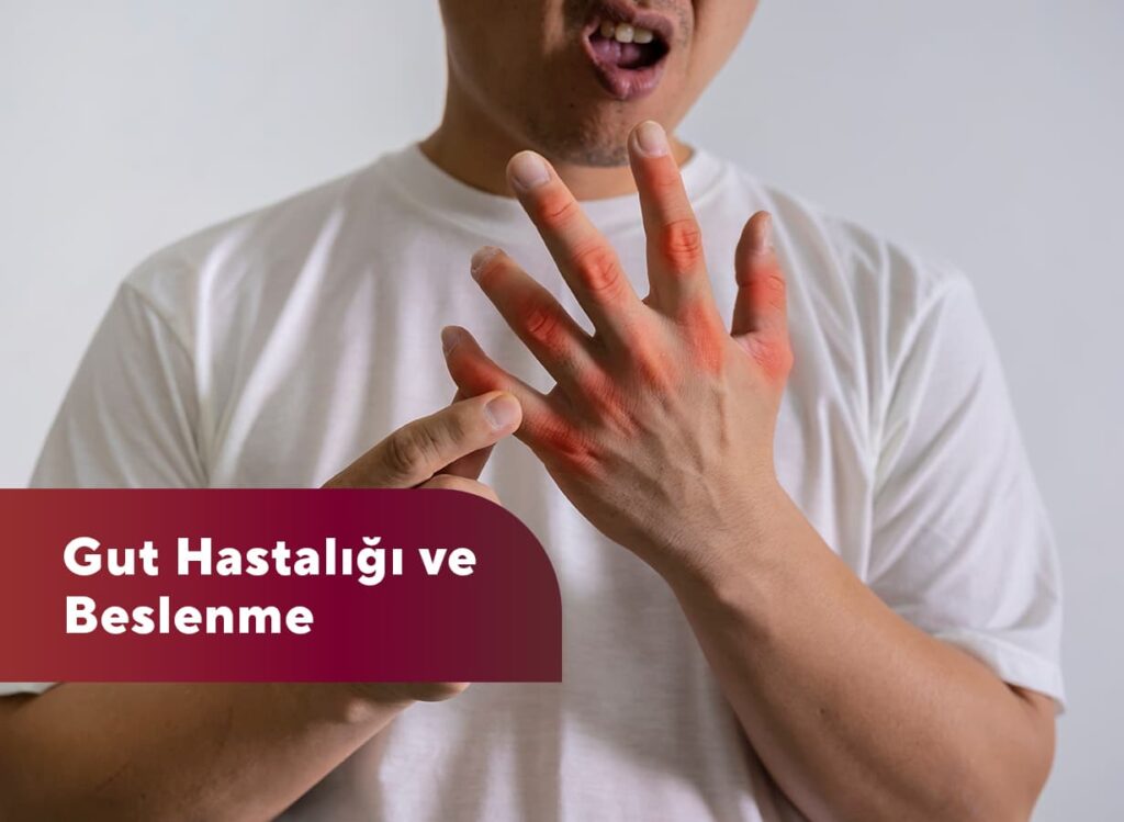Gut Hastalığı ve Beslenme - Mücteba Gündüz